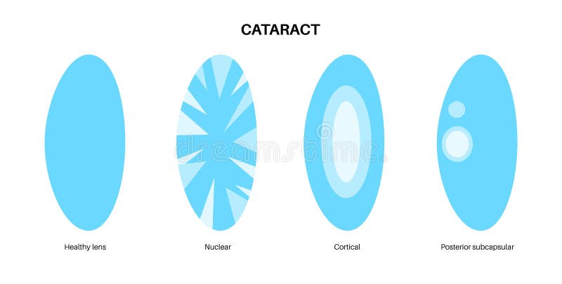 Cataract eye disease stock vector. Illustration of vector - 327730810