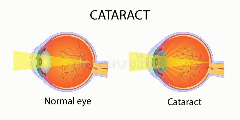 Cataract, Visual Disorder, Image of Normal Vision and Vision with ...
