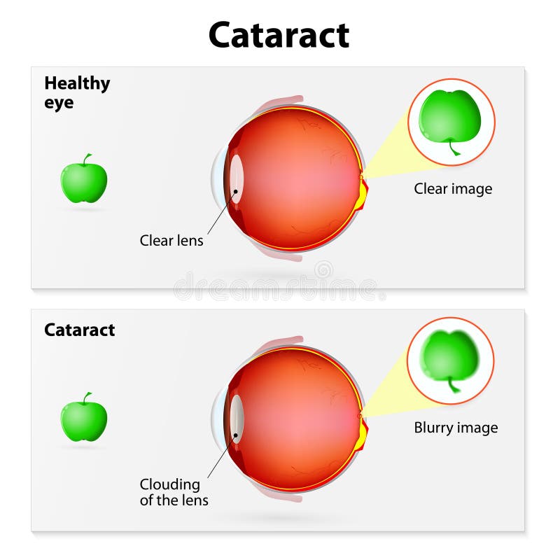 Cataracte illustration de vecteur. Illustration du eyeball - 54558376