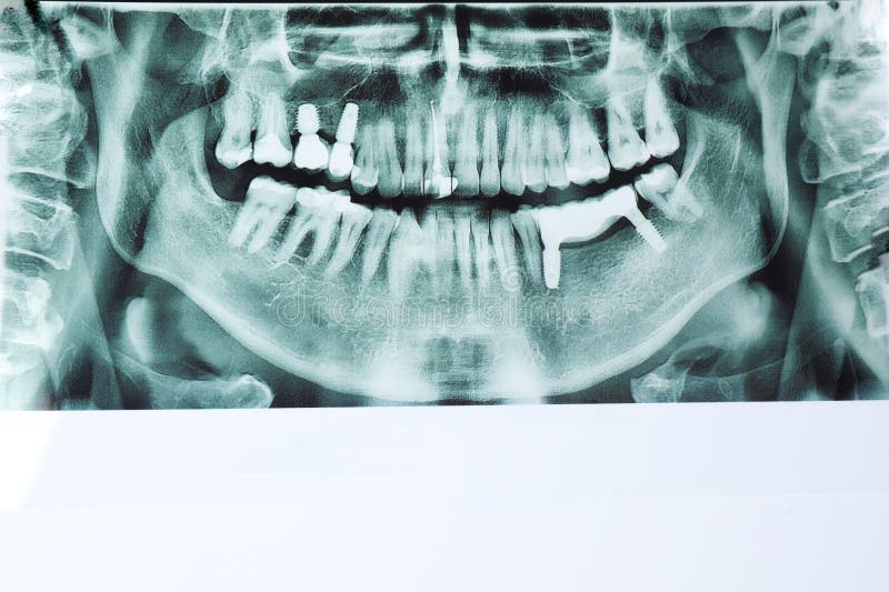 Cate Fluorography Diagnostics of the Nasal Cavity Stock Image - Image ...