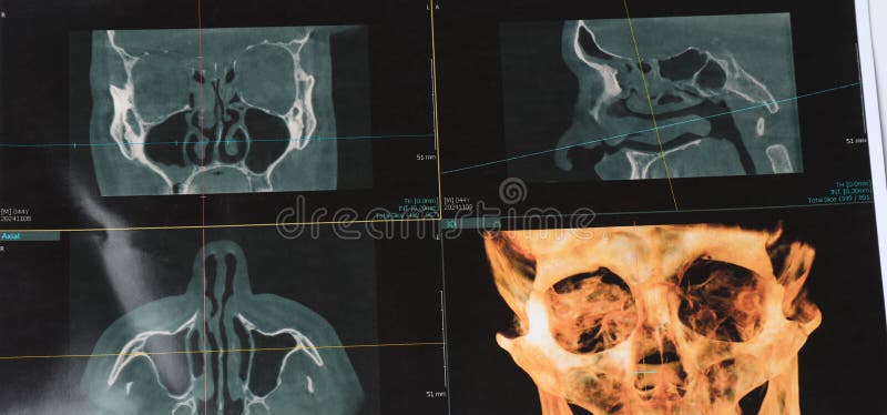 Cate Fluorography Diagnostics of the Nasal Cavity Stock Image - Image ...
