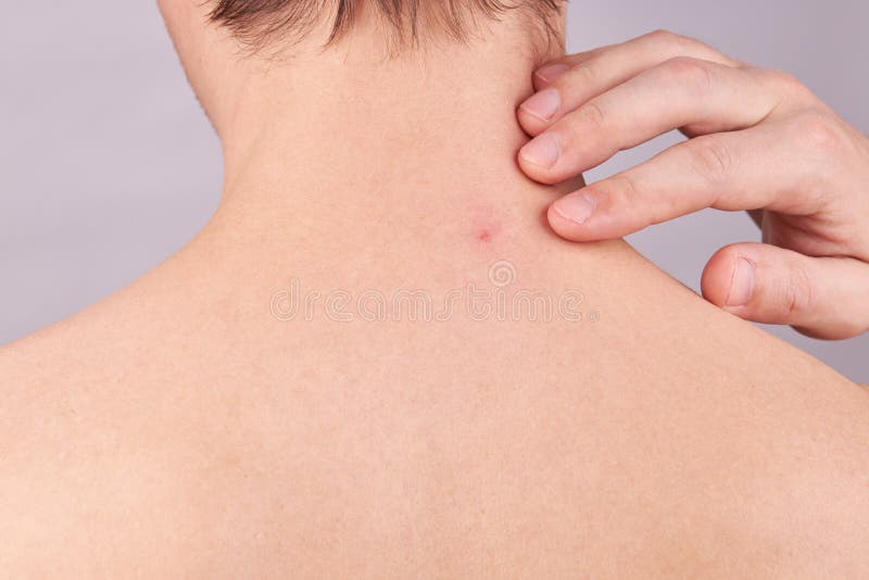 Caucasian Male with Skin Problems. Acne Check Stock Image - Image of ...