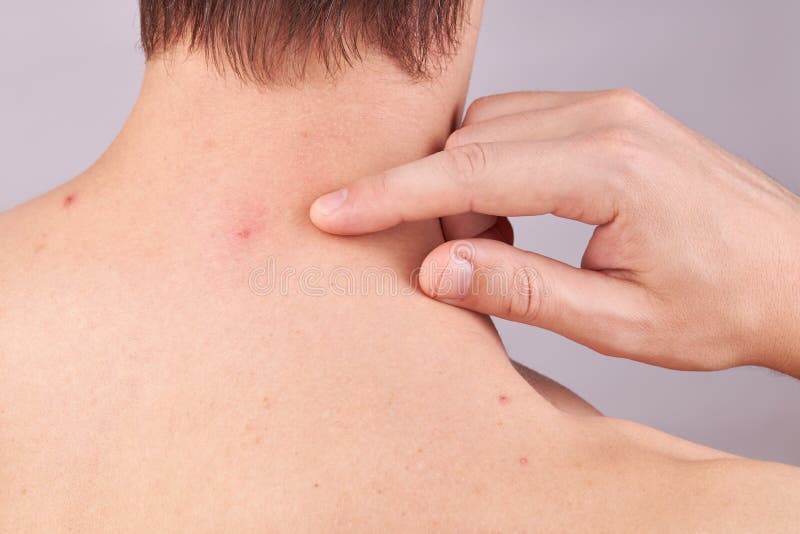 Caucasian Male with Skin Problems. Acne Check Stock Image - Image of ...