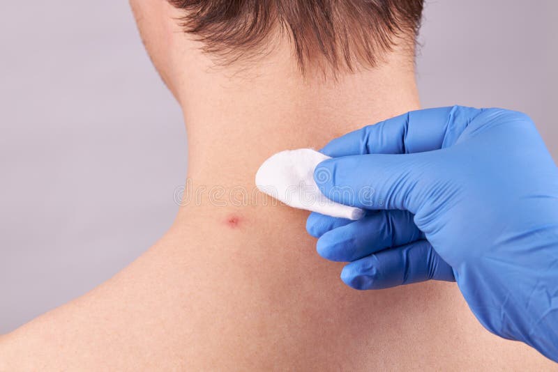 Caucasian Male with Skin Problems. Acne Check Stock Image - Image of ...