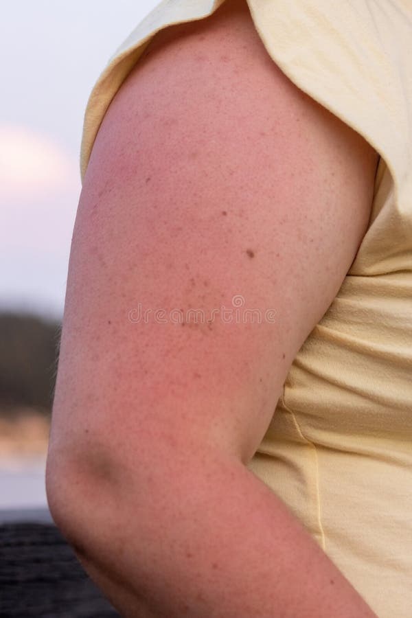 Caucasian Arm Red from a Sun Burn in Mid Summer Stock Image - Image of ...