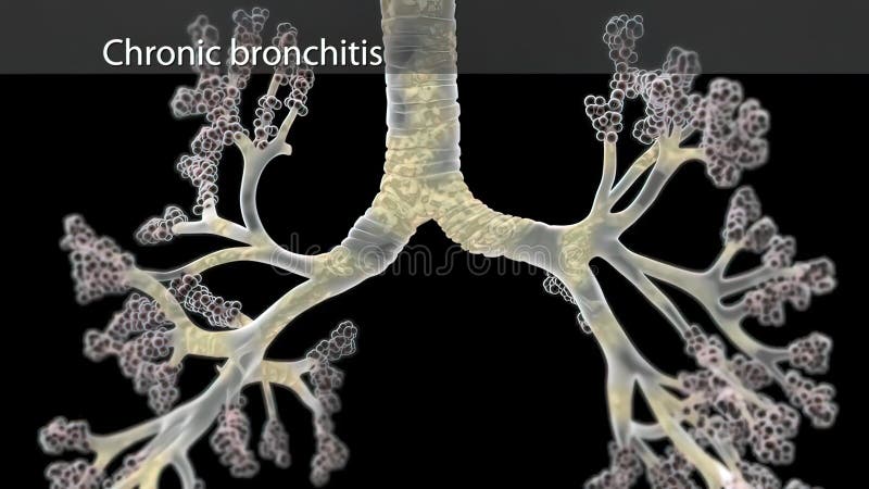 Bronchi Mucus Stock Illustrations – 240 Bronchi Mucus Stock ...