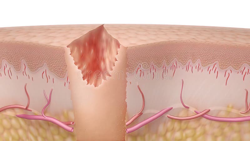 Caused by a Sharp Object. Scrapes, Abrasions, Scratches and Floor Burns ...