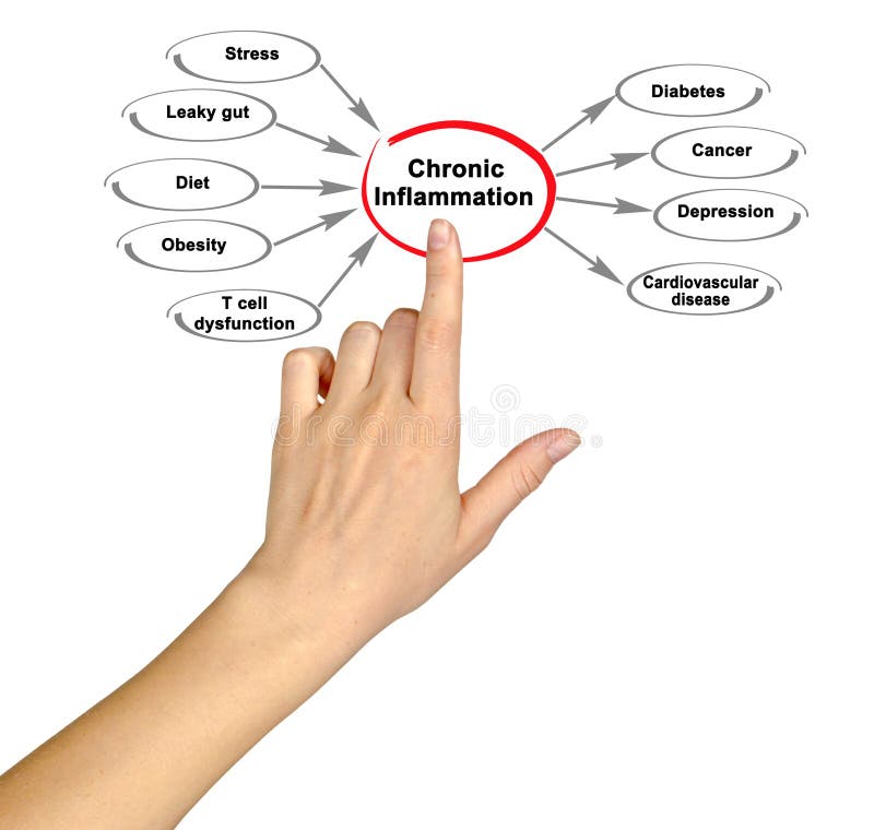 Causes of Chronic Inflammation Stock Photo - Image of finger, pointing ...
