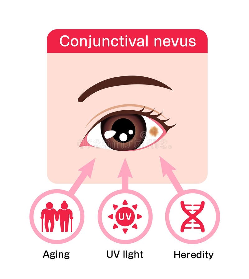 Causes of Conjunctival Nevus Vector Illustration Stock Illustration ...