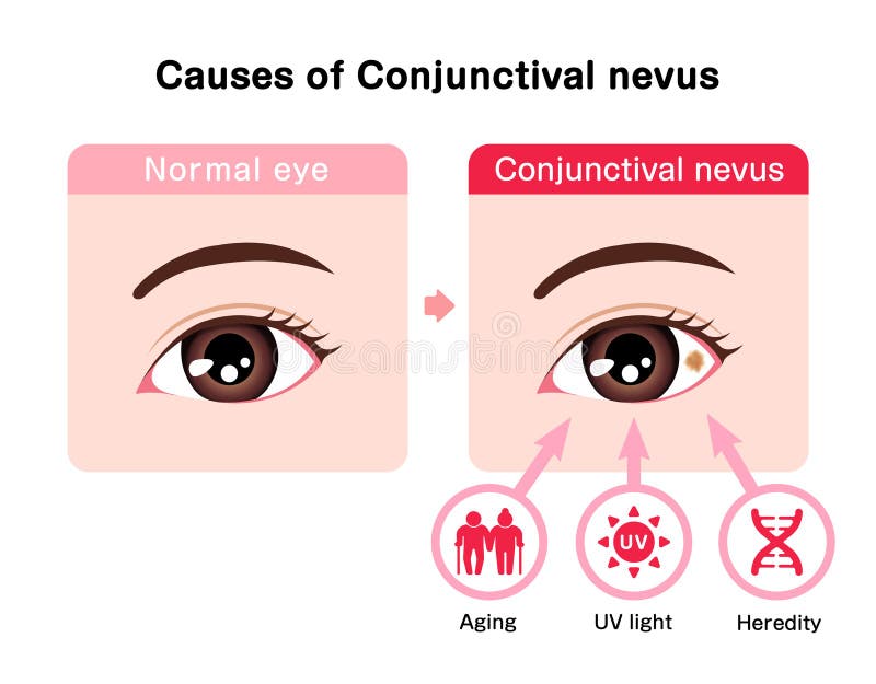 Causes of Conjunctival Nevus Vector Illustration Stock Vector ...