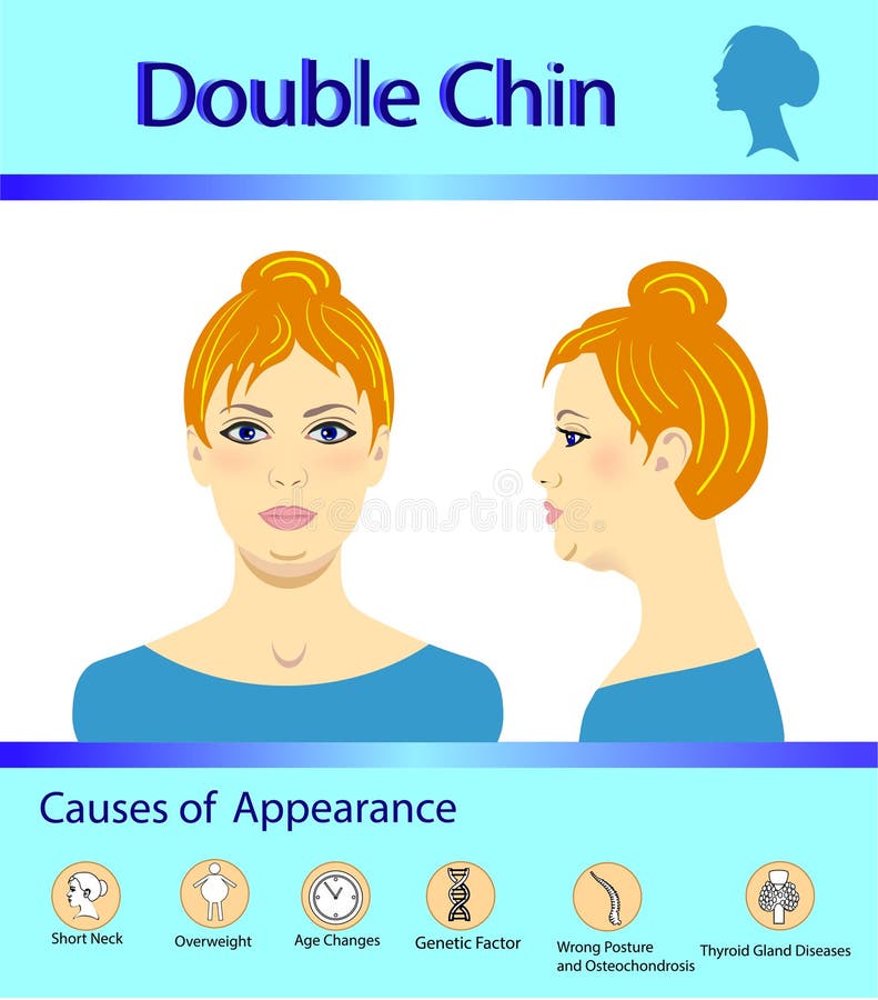 Double Chin, Before And After Treatment Stock Vector - Illustration of ...