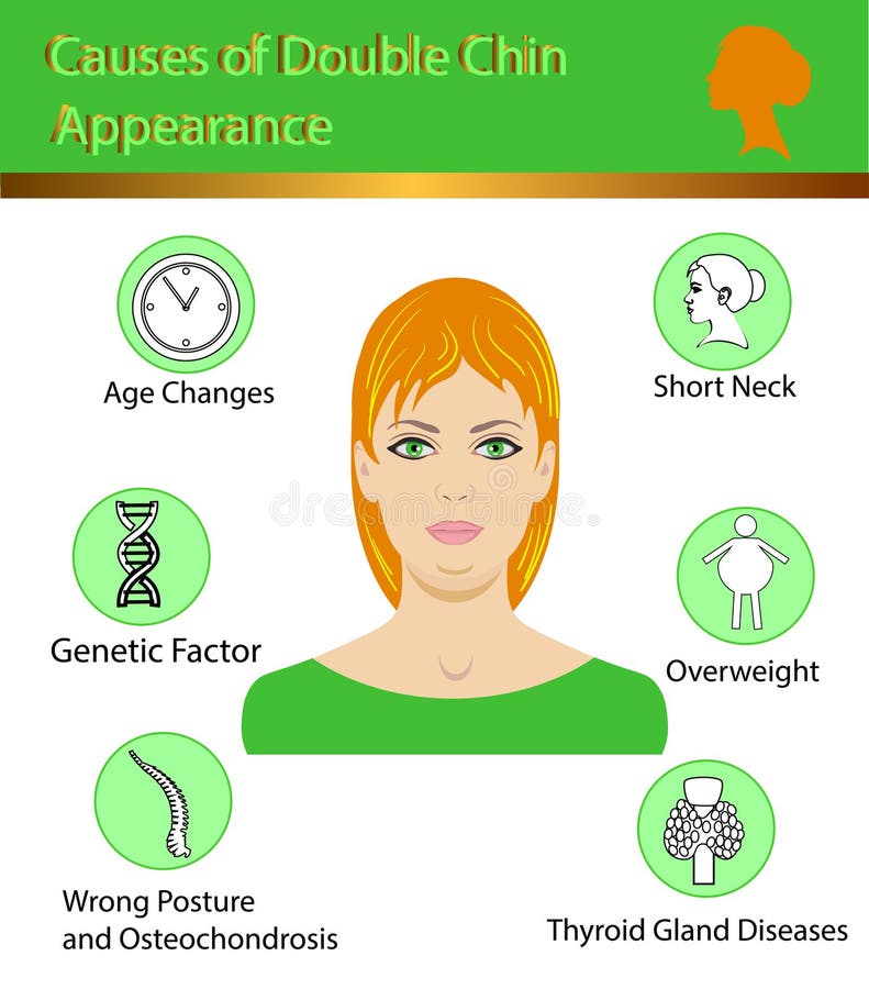 Causes of Double Chin, Vector Illustration Diagram Stock Vector ...
