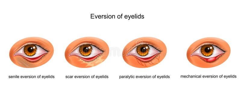 The Causes of Eversion of Eyelids Stock Vector - Illustration of ...