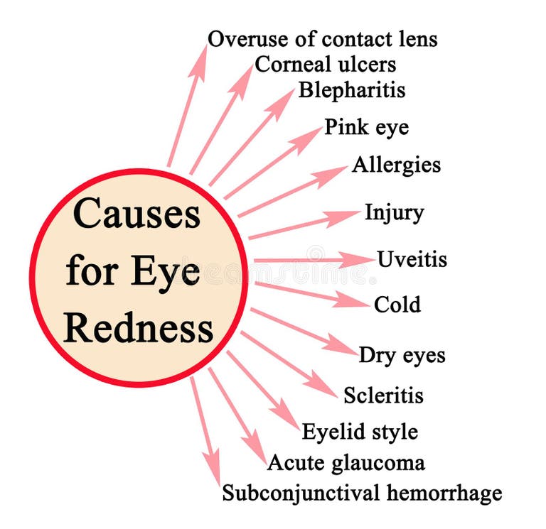 Causes for Eye Redness stock illustration. Illustration of corneal ...