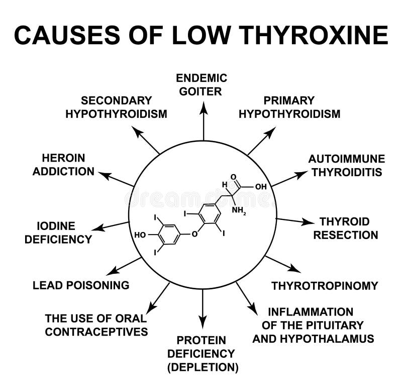 The Causes of Thyroid Hypothyroidism. Infographics. Vector Illustration ... The Causes of Thyroid Hypothyroidism. Infographics. Vector Illustration ...