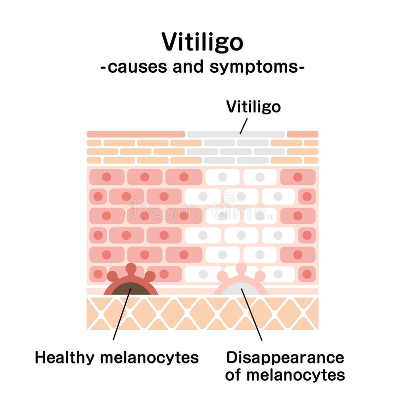 Causes and Symptoms of Vitiligo Vector Illustration Stock Vector ...