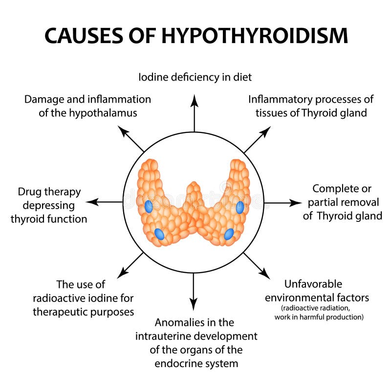 Hypothyroidism Vector Illustration. Labeled Underactive Thyroid ...