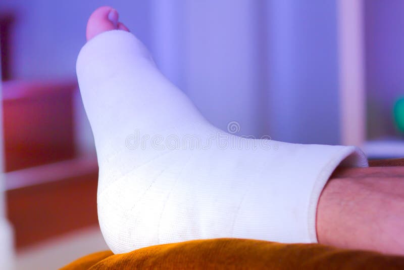 Caviglia rotta immagine stock. Immagine di umano, piedino - 30788231