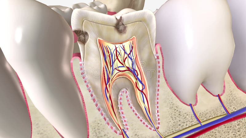 Cavities are Permanently Damaged Areas in the Hard Surface of Your ...
