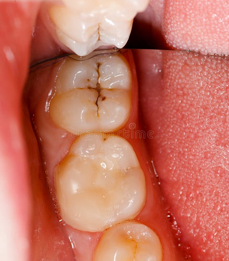 Cavity and teeth stock image. Image of disease, macro - 29699159