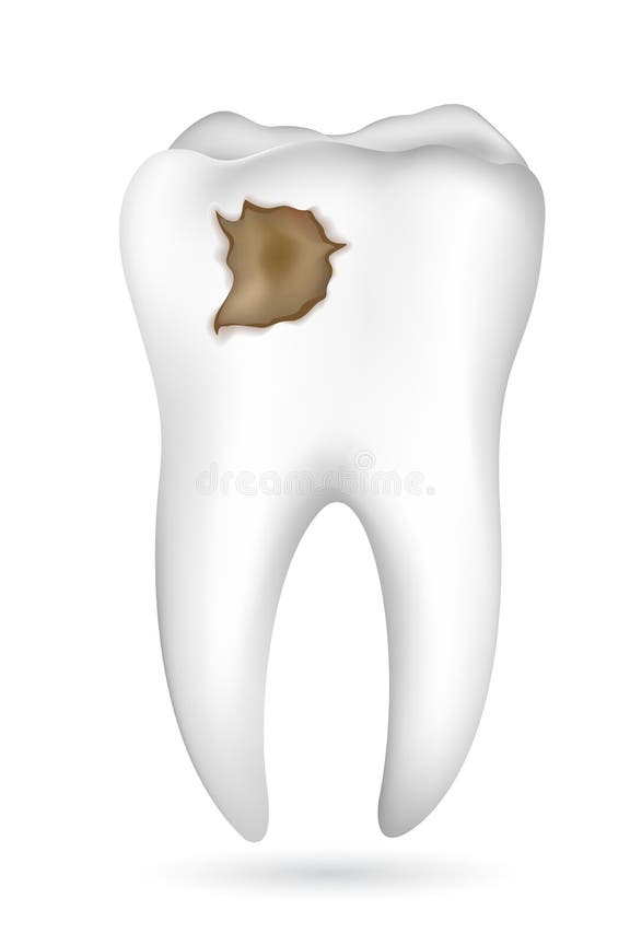 Tooth Structure Cavity Stock Illustrations – 1,185 Tooth Structure ...