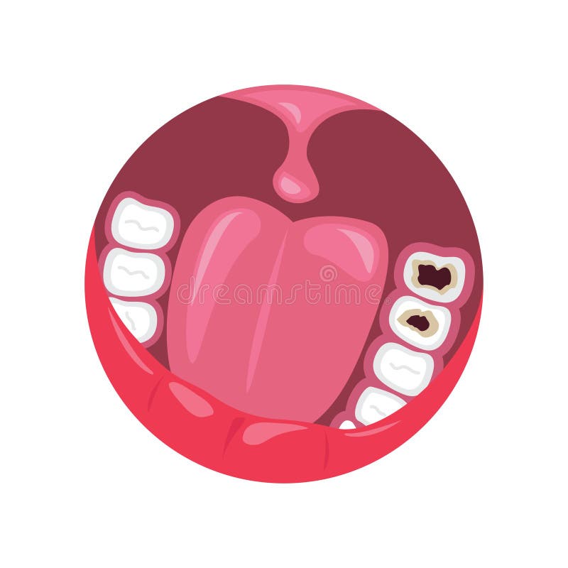 Cavity in the Tooth Cartoon Vector Element Design Template Stock Vector ...