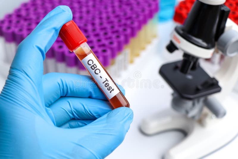 CBC Test for Abnormalities in Red Blood Cells, Blood Samples To Be ...