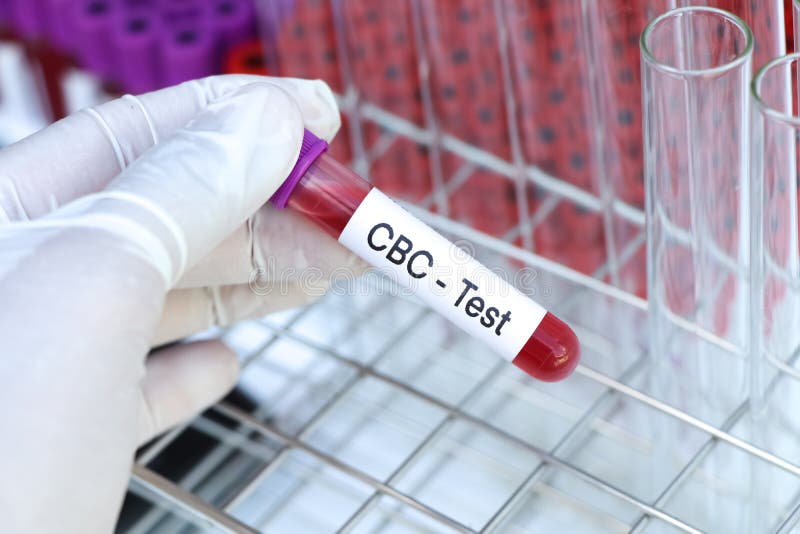 CBC Test To Look for Abnormalities from Blood, Blood Sample To Analyze ...
