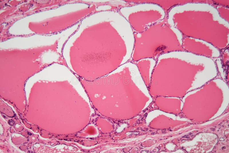 Cells of a Human Thyroid Gland with Swelling Under a Microscope Stock ...