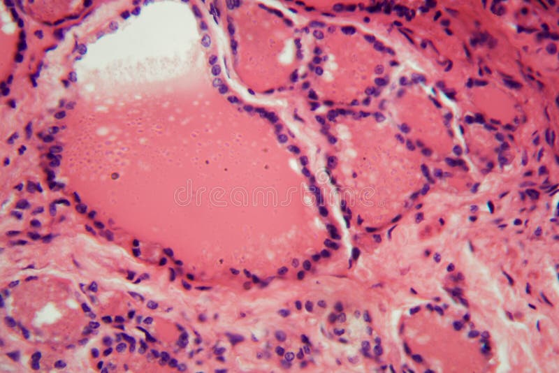 Cells of a Human Thyroid Gland with Swelling Under a Microscope Stock ...