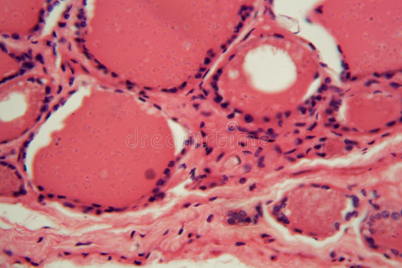 Cells of a Human Thyroid Gland with Swelling Under a Microscope Stock ...