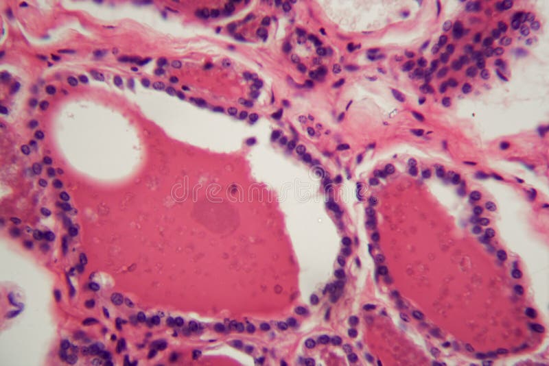 Cells of a Human Thyroid Gland with Swelling Under a Microscope Stock ...