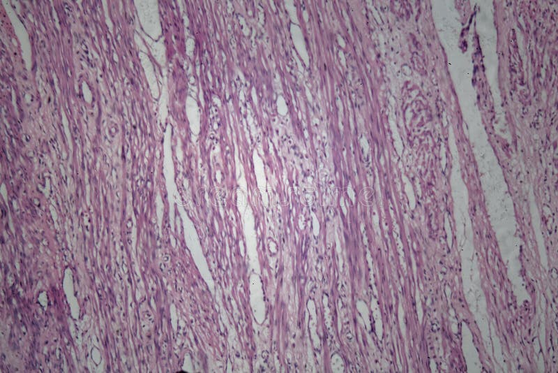 Cells of Human Uterus Tissue with Inoffensive Tumor Cells Stock Photo ...