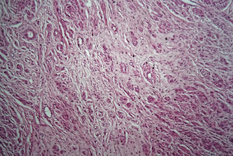 Cells of a Human Uterus with Uterine Fibroids Stock Image - Image of ...