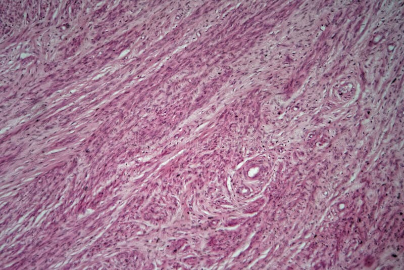 Cells of a Human Uterus with Uterine Fibroids Stock Photo - Image of ...