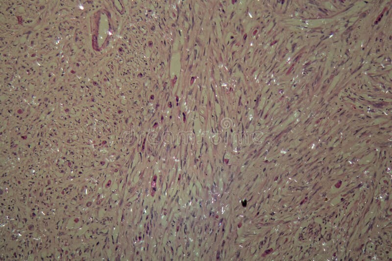 Cells of testicular cancer stock image. Image of clinic - 87354599