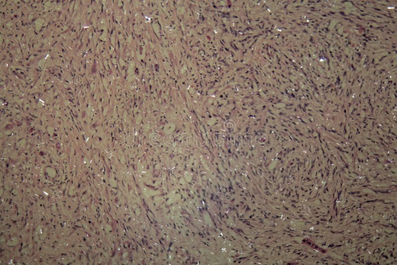 Cells of testicular cancer stock image. Image of experiment - 87361569