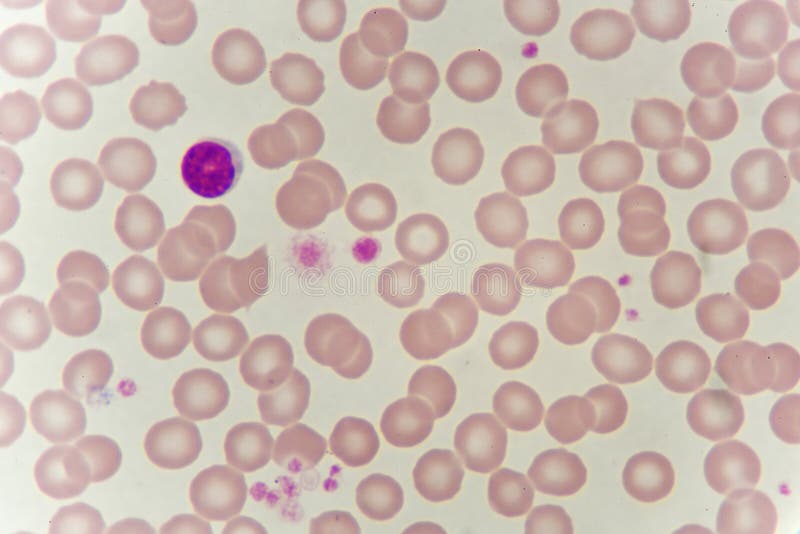 Cellule De Lymphocyte Dans La Calomnie De Sang Photo stock - Image du ...
