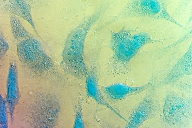 Cellule Tumorali Cervicali HeLa Fotografia Stock - Immagine di ...