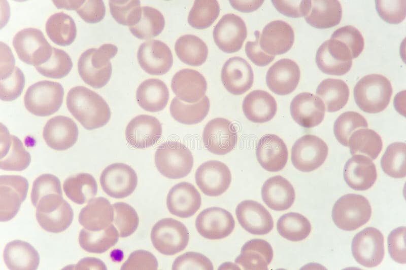 Cellules Cibles Avec Les Globules Rouges Anormales Photo stock - Image ...