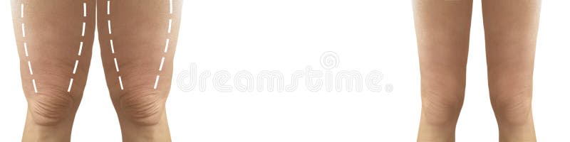 Cellulite Female Legs before after Losing Weight Stock Photo - Image of ...