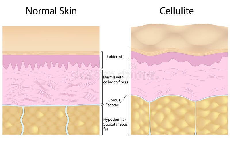 The Formation of Cellulite. Vector Diagram Stock Vector - Illustration ...