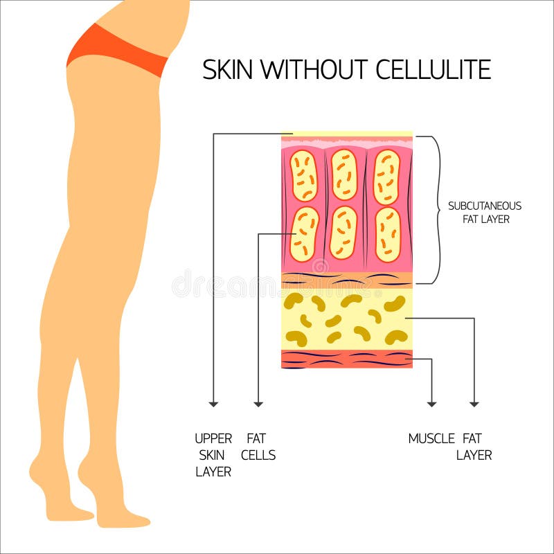 Cellulite and normal skin stock vector. Illustration of cellulite ...