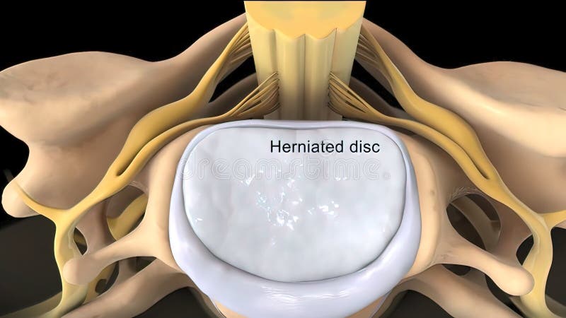 Disc Protrusion. Top View. Spine. Infographics. Vector Illustration on ...