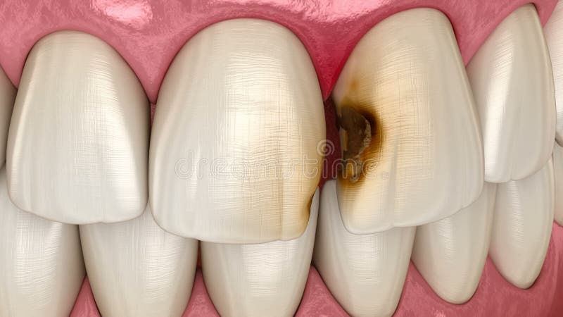 Central Incisor Teeth Damaged by Caries. Medically Accurate Tooth ...