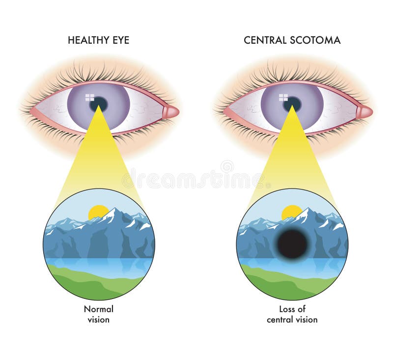 Central scotoma stock illustration. Illustration of medical - 238535815