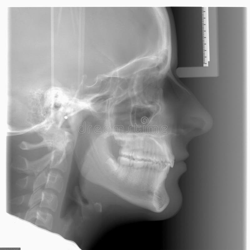 Cephalometric X-ray Used in Dentistry and Orthodontics Stock Photo ...