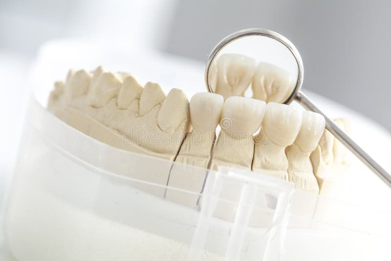 Ceramic Bridge on Plaster Model Stock Photo - Image of oral, artificial ...