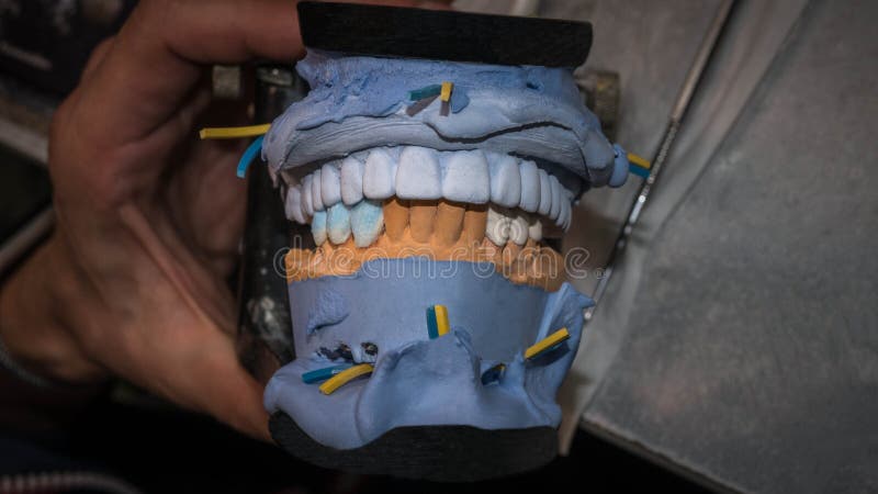 Ceramic Crown of a Tooth on a Plaster Model of Teeth, the Work of a ...