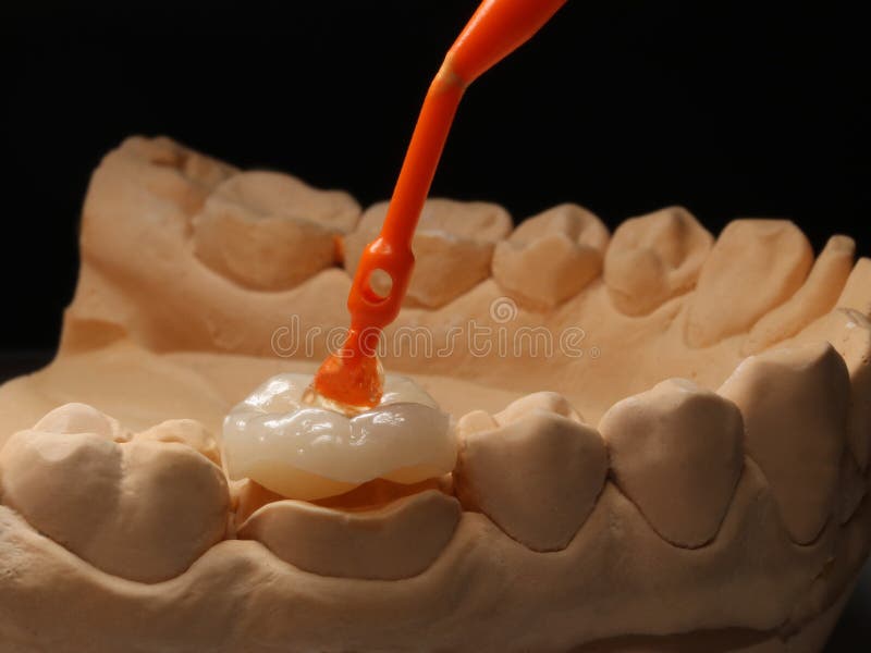 Ceramic Emax Crown on the Model Stock Image - Image of helsinki, dental ...